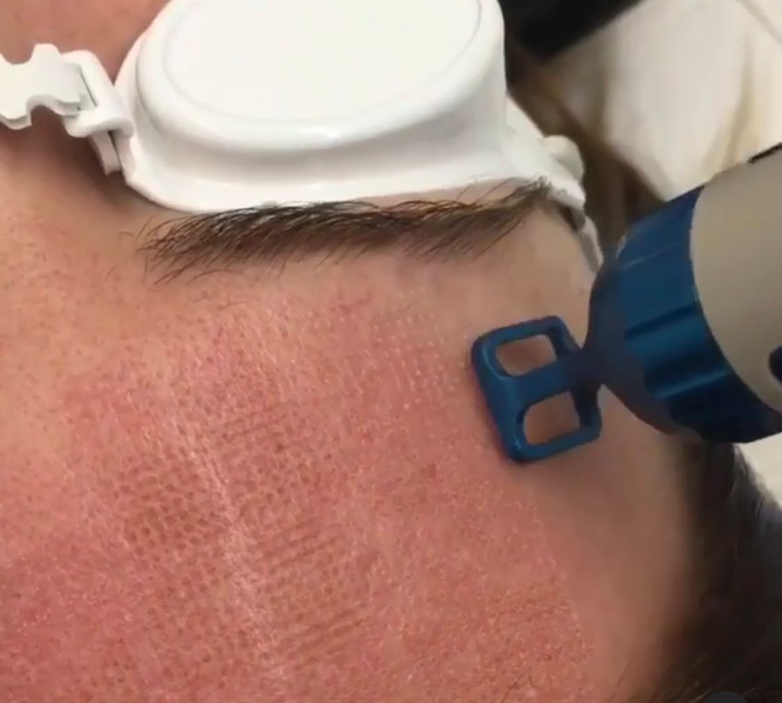 iPixel laser by Alma Lasers | CULTSKIN®