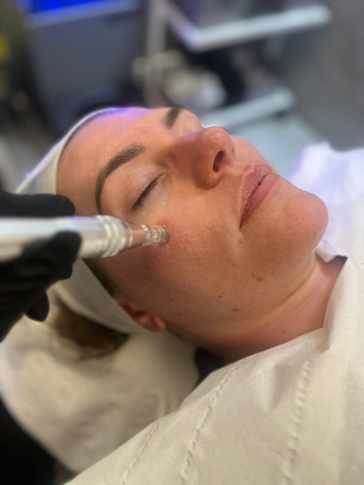 Nano-Needling Skin Treatment - London & Dubai | CULTSKIN®